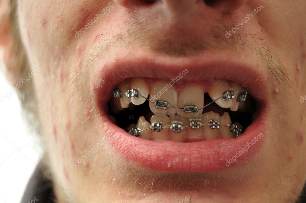 Close up of crooked teeth with braces — Stock Photo © vlue #4626160